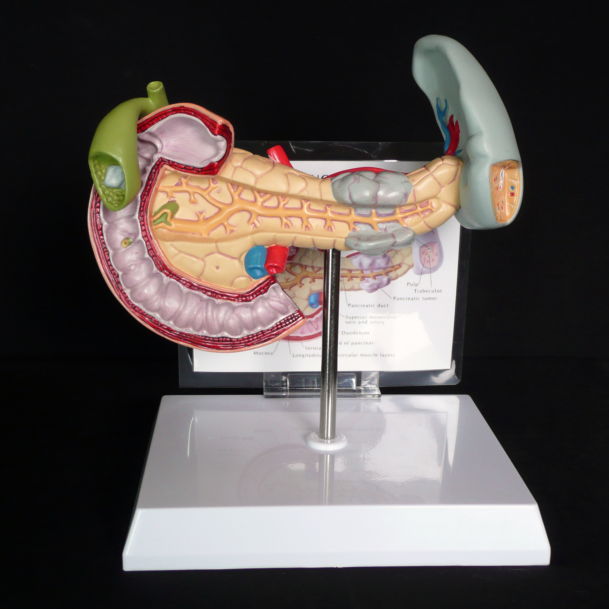 Anatomical Human Pancreas, Spleen and Gallbladder Pathological Diseases ...
