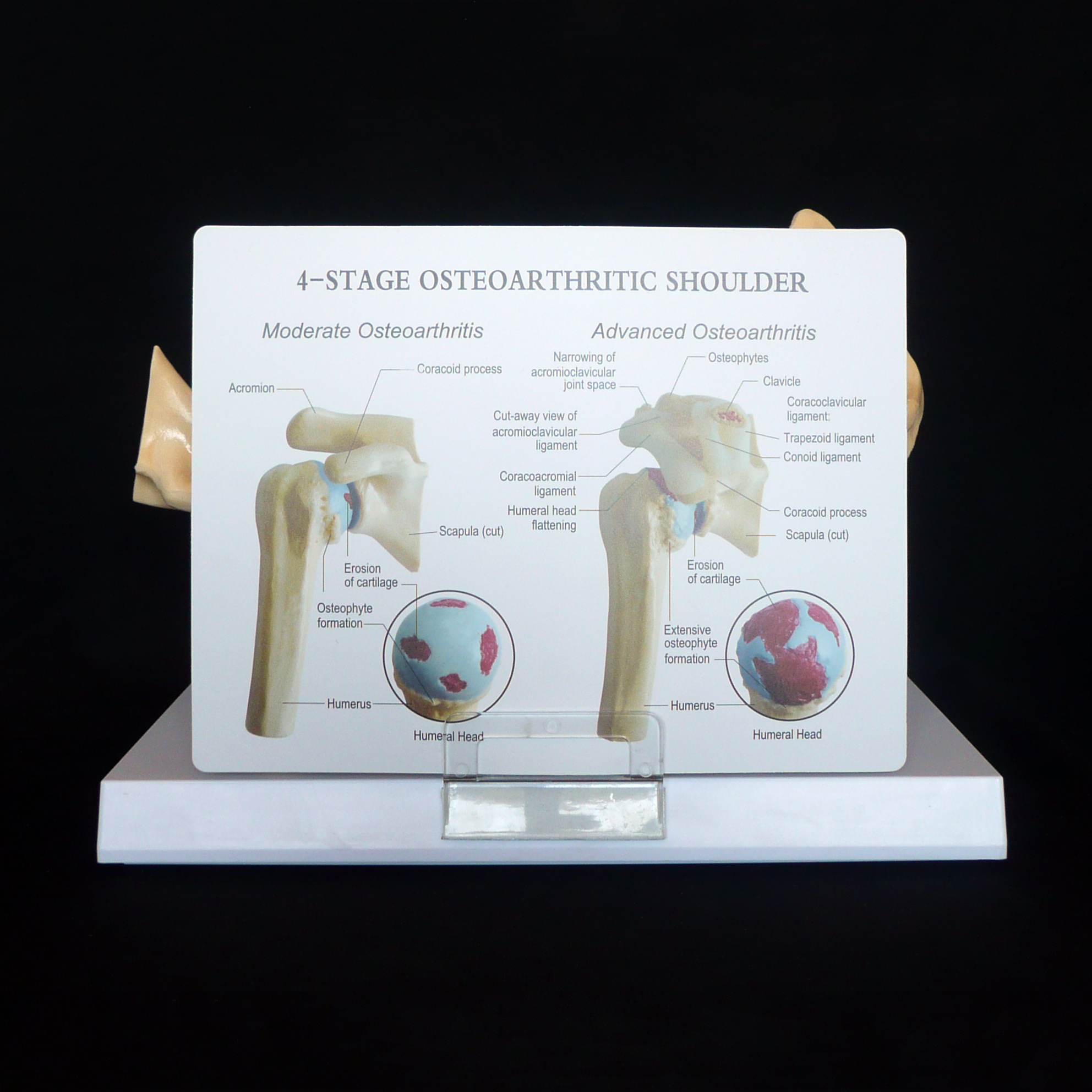 Anatomical Human Shoulder 4-Stage Osteoarthritic Glenohumeral Joint ...