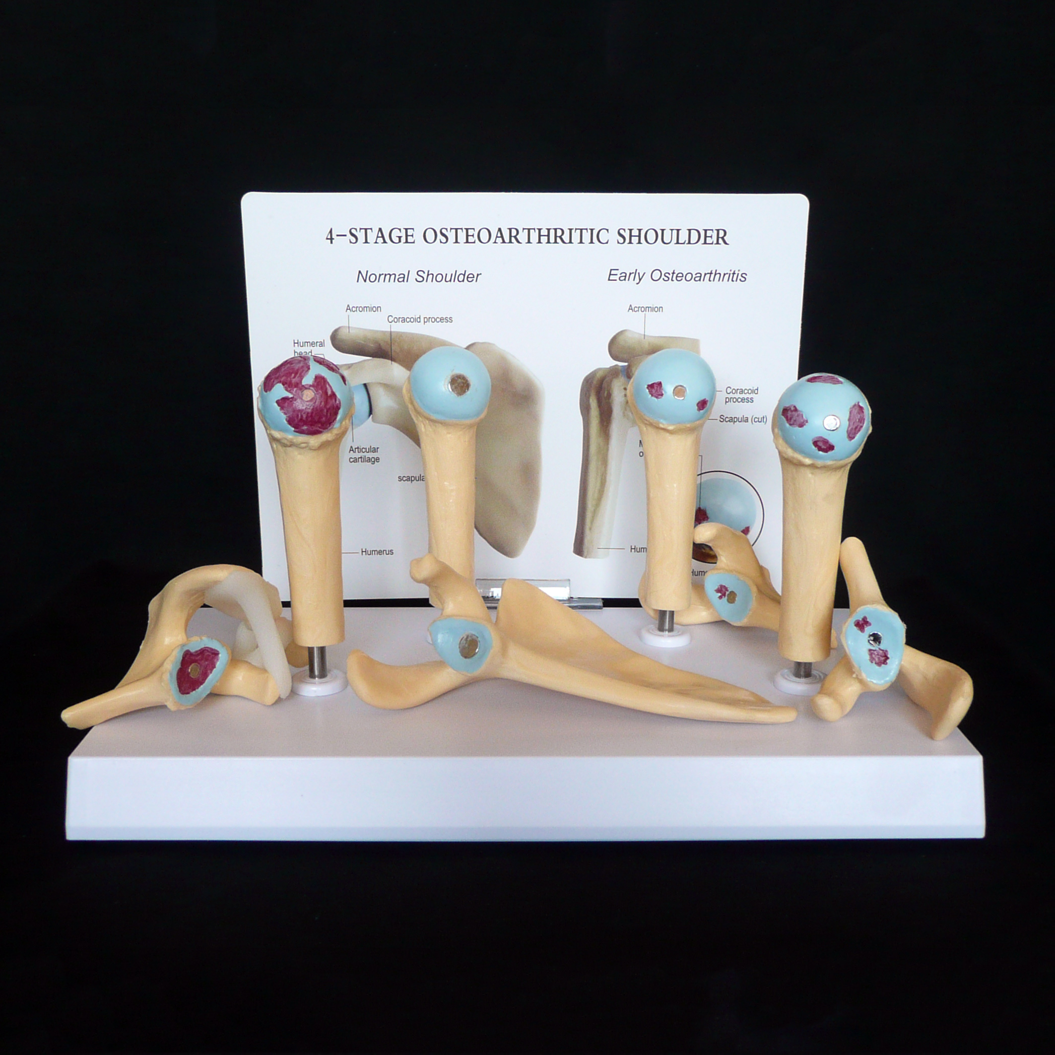 Anatomical Human Shoulder 4-Stage Osteoarthritic Glenohumeral Joint ...