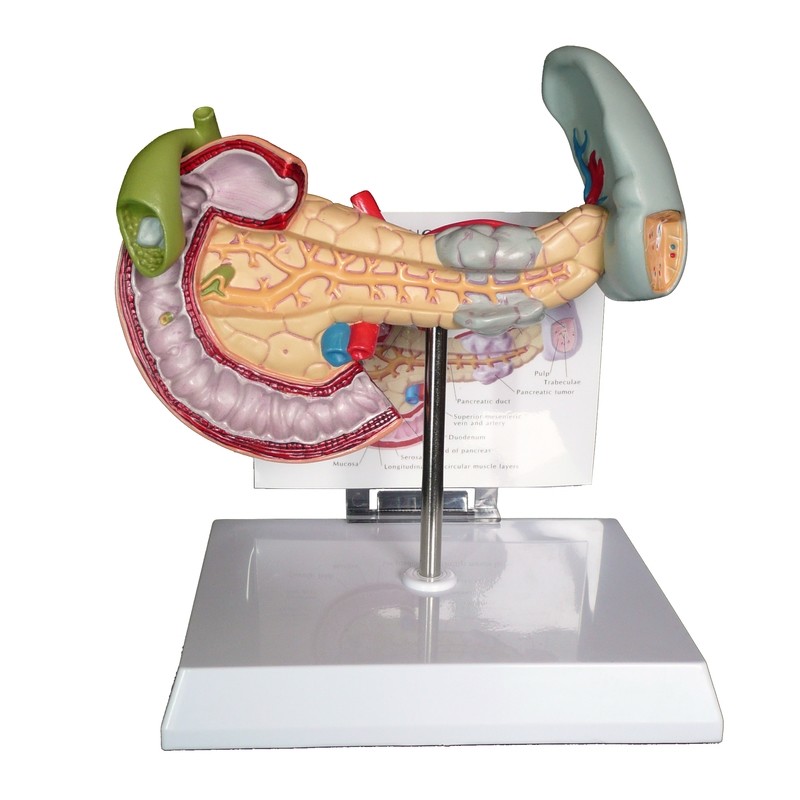 Anatomical Human Pancreas, Spleen and Gallbladder Pathological Diseases ...